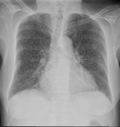 Faces Of Miliary Disease The Common Vein