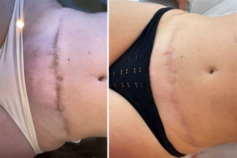 Scar Tattoos All About Tummy Tuck Scar Tattoo Fernanda Jaffre