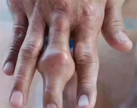 山竹丹 痛風？山竹丹幫到你 介紹個好產品給你們 Facebook