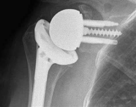 Common Shoulder Problems Flashcards Quizlet