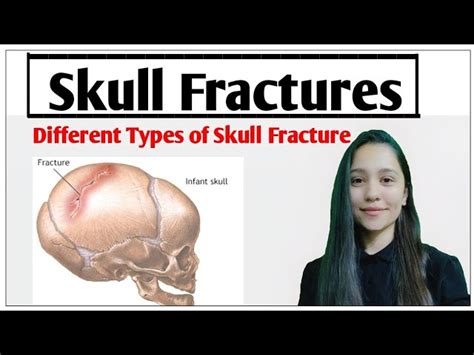 Types Of Skull Fracture