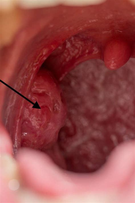 Tonsil Crypts Stones