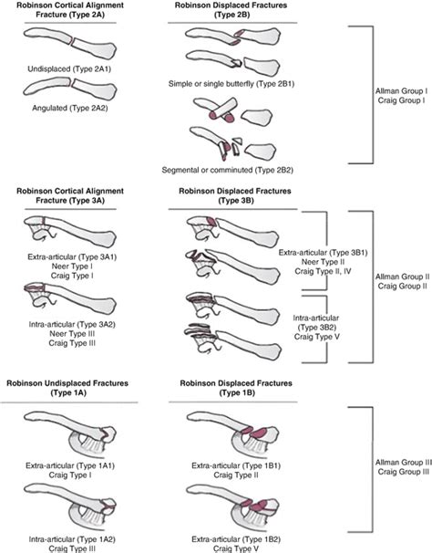 Clavicle Fracture Classification