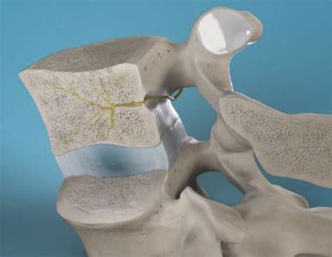 Basivertebral Nerve Ablation Newsletter Dr David Provenzano