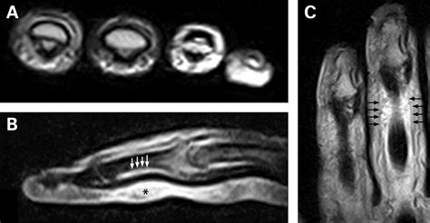 Dactylitis In Gout Annals Of The Rheumatic Diseases