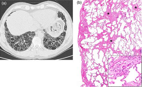 Panel A Fibrotic Hypersensitivity Pneumonitis A 59 Year Old Man With