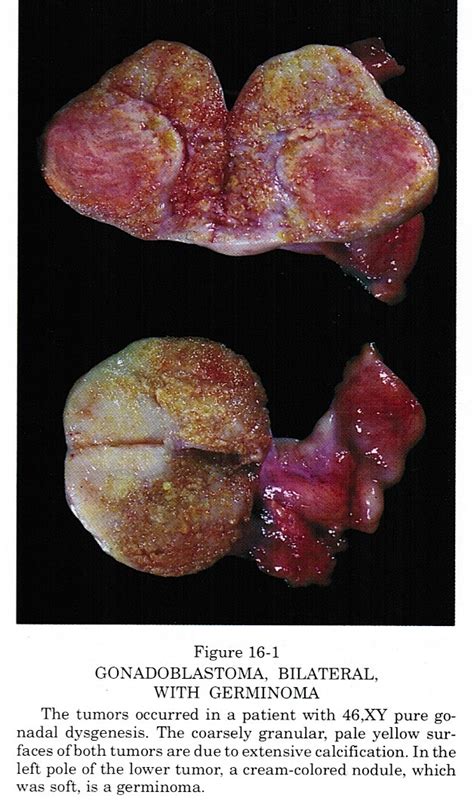 Pathology Outlines Gonadoblastoma