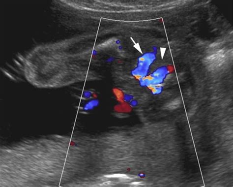 Bladder Exstrophy Ultrasound