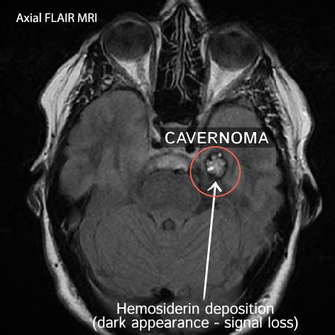 Neurological System Glossary Cavernoma Aka Cerebral Cavernous