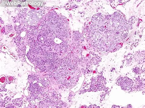 Chondroid Lipoma Microscopic Features