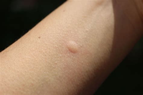 Itchy White Bumps On Skin White Bumps On Face Expert Explains The