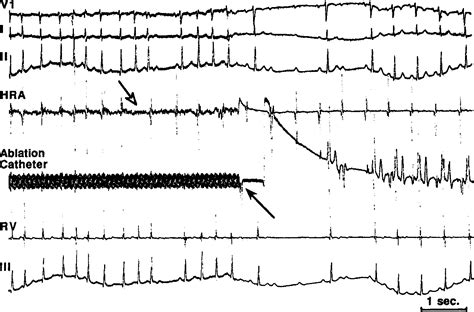 Figure 1 From Analysis Of Junctional Ectopy During Radiofrequency