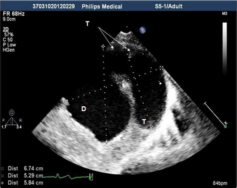 Isolated Giant Congenital Diverticulum Of The Left Ventricle In