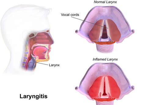 What Role Does Hydration Play In Preventing And Treating Laryngitis