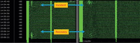 Multimodal Intraoperative Neurophysiological Monitoring With Special