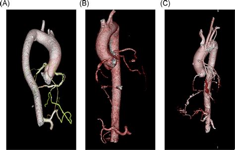 Postoperative Computed Tomography Ct Scan Results Of The Three