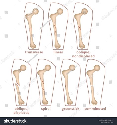 Infographic Types Fractures Human Femur Medical Stock Vector Royalty Free
