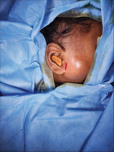 Parotid Gland Abscess In An Underweight Infant A Comprehensive Analysis Karnataka Paediatric