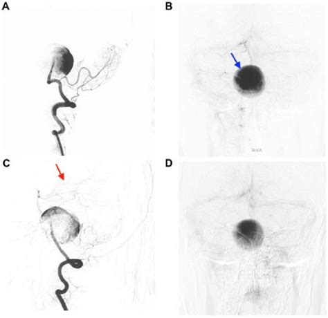 Angiography Prior To Embolization A Pca Was Not Observed On