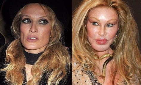 Before And After Plastic Surgery