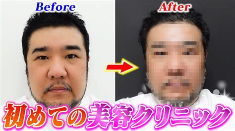 【美容】堤下敦、初めての美容クリニックへ Youtube