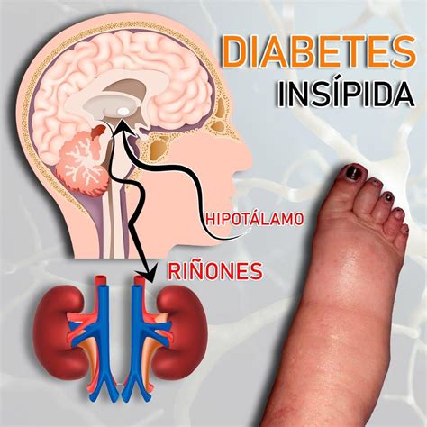 Diabetes Insípida Síntomas Causas Y Tratamiento Diabetes Insípida Síntomas Causas Y