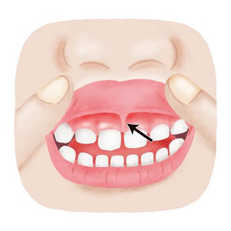 舌小帯・上唇小帯 歯科用語