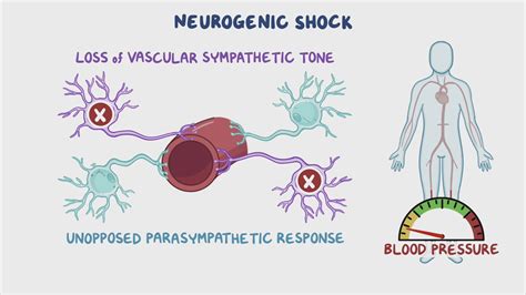 Video Neurogenic Shock Clinical Sciences Osmosis