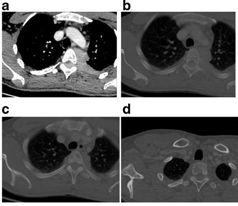 Ct Chest Withcontrast Soft Tissue Window Show Left Paraspinal Mass Download Scientific Diagram