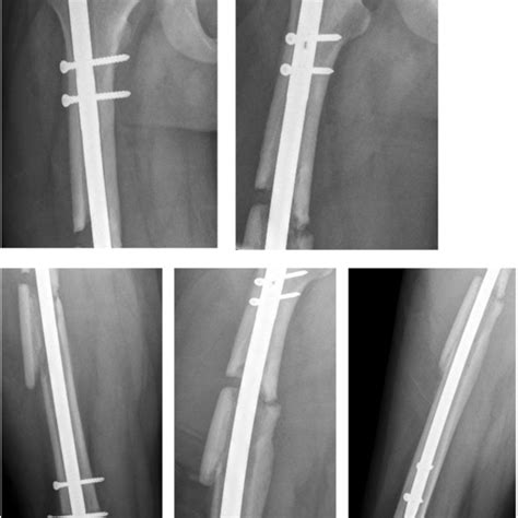 Pdf Management Of Twenty Centimeter Segmental Bone Defect Of Femoral Shaft Secondary To