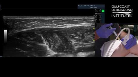 How To Hydrodissect And Block The Ulnar Nerve Using Ultrasound Guidance Gulfcoast Ultrasound