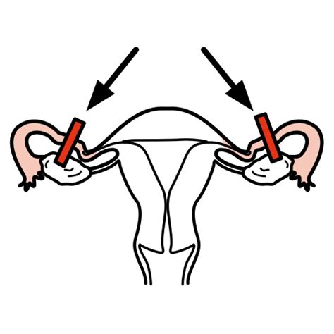 Tubal Ligation In ARASAAC Global Symbols