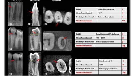 Conservative Endodontic Treatment For Cervical Invasive Resorption