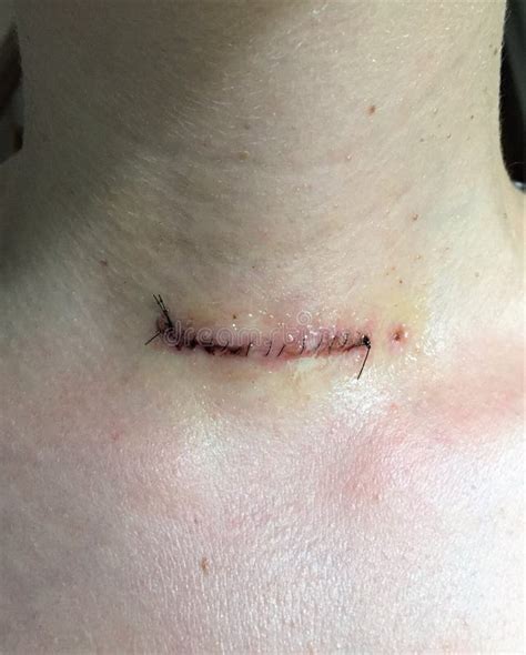 Thyroidectomy Surgery Scar With Stitches Stock Image Image Of