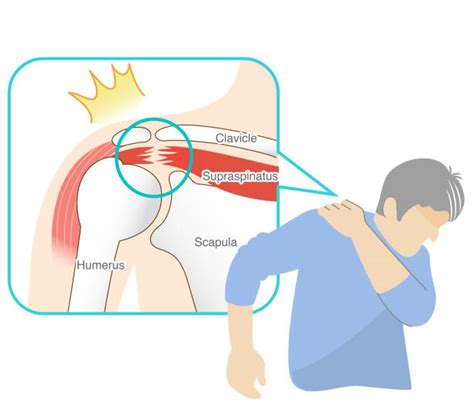 50 Tendinitis De Bíceps Fotografías De Stock Fotos E Imágenes Libres