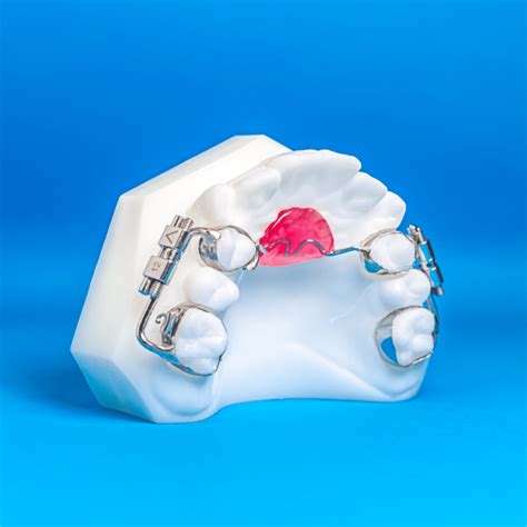 Rapid Molar Distalizer Specialty Appliances