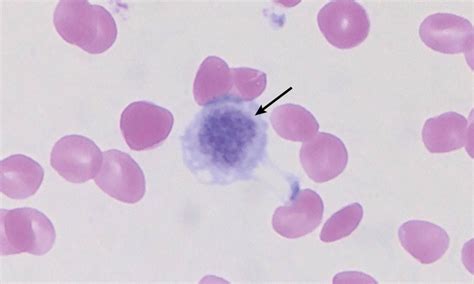 Clinical Image What Cell Is The Arrow Pointing To