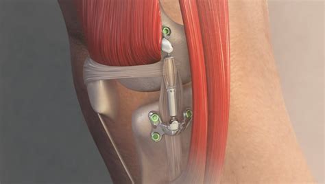 Misha Overview Misha Knee System