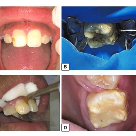 A Enamel Defect And Caries Distal To Element 11 B Rubber Dam Download Scientific Diagram