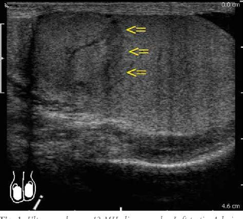 Figure 1 From Capillary Hemangioma Of The Testis A Case Report Of A