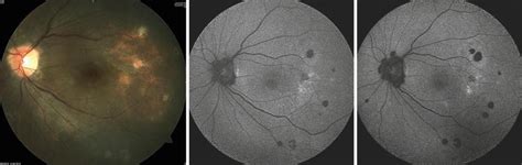Choroiditis And Panuveitis Ento Key
