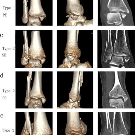 The Modified Pankovich Classification And The Herscovici Classification Download Scientific