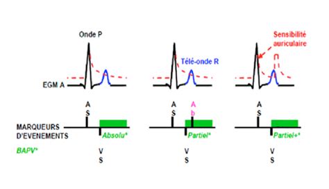 Pacemaker Atrial Refractory Periods Pvarp Pvab Arp Cardiocases