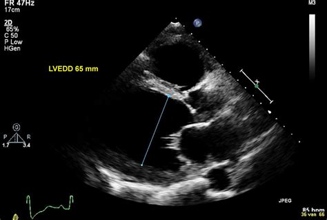 Dilated Cardiomyopathy Echo