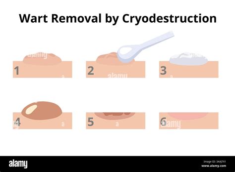 Cryodestruction Procedure Showing Six Steps Of Wart Removal Process