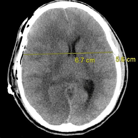 Head Ct Scan Post Decompressive Craniectomy On Day Two Shows Severe
