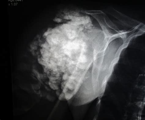 Hyperparathyroidism Secondary Chronic Renal Disease Rojoson Medical
