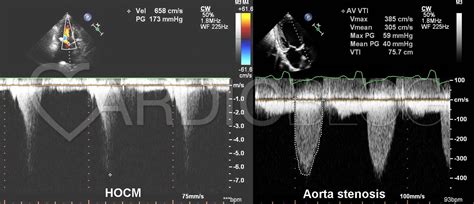 Hypertrophiás Obstruktív Cardiomyopathia öreg Korában Sincs Nyugta Az