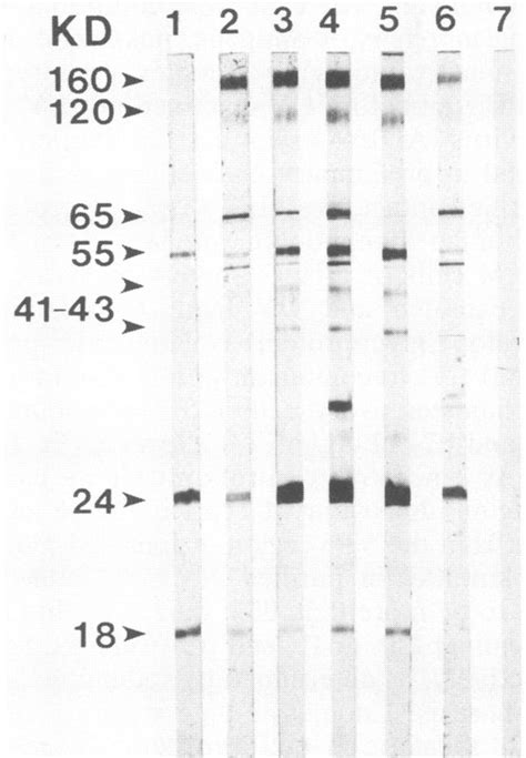Western Blot Analysis Of Sera From Hiv Infected And Control
