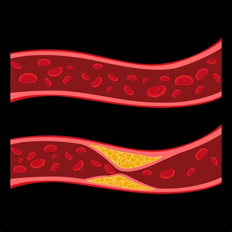 Plaque In Artery Clip Art